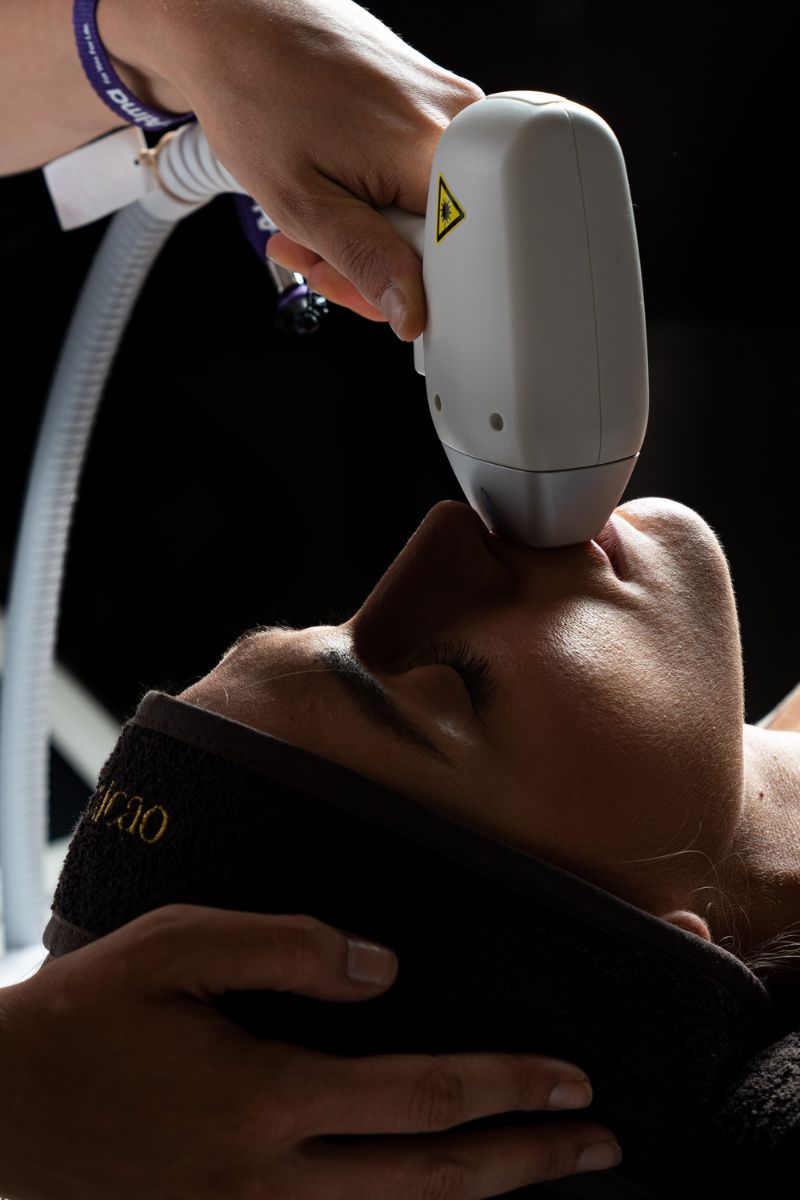 Epilazione laser viso - -50% di sconto - Mimicao - Torino